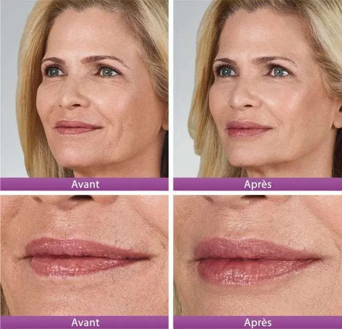 Injection Levre, Augmentation des Levres - LAZEO